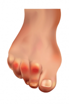 Schoenen voor hamertenen, welke zijn geschikt en welke niet? | Penninx